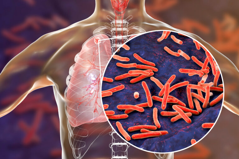 Tuberculosis Genome Mapping in Italy: How 2,520 Strains Are Shaping the ...